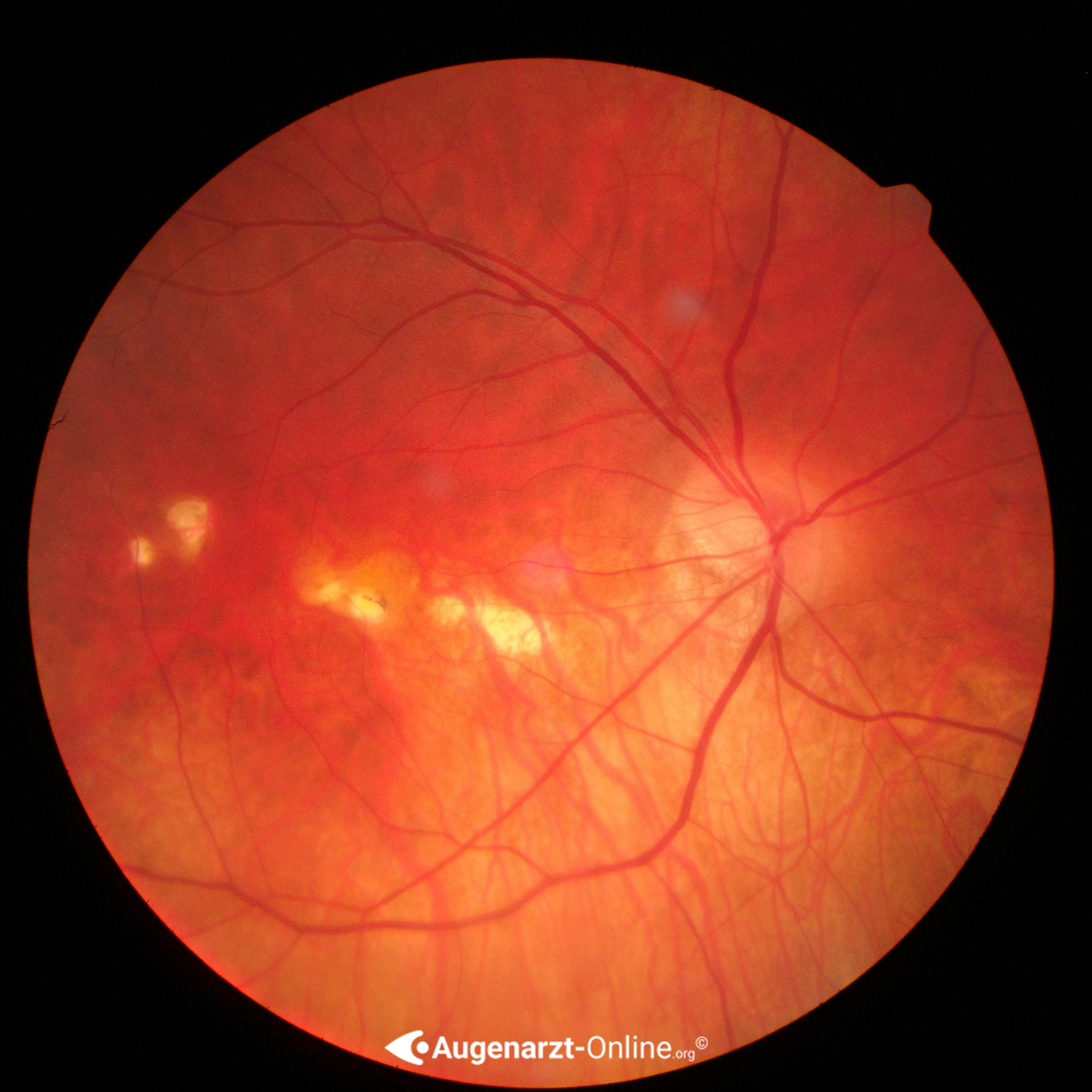 Lacquer cracks | Atlas der Augenheilkunde